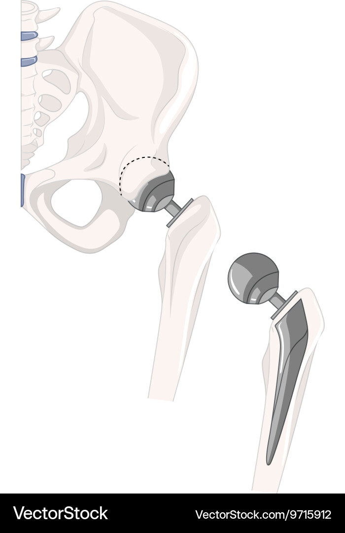 Treatment of human hip bone Royalty Free Vector Image