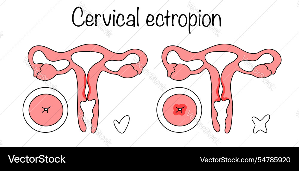 Cervical ectropion Royalty Free Vector Image - VectorStock