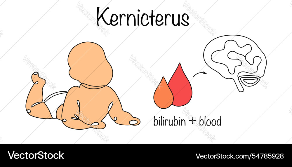 Kernicterus Royalty Free Vector Image - VectorStock