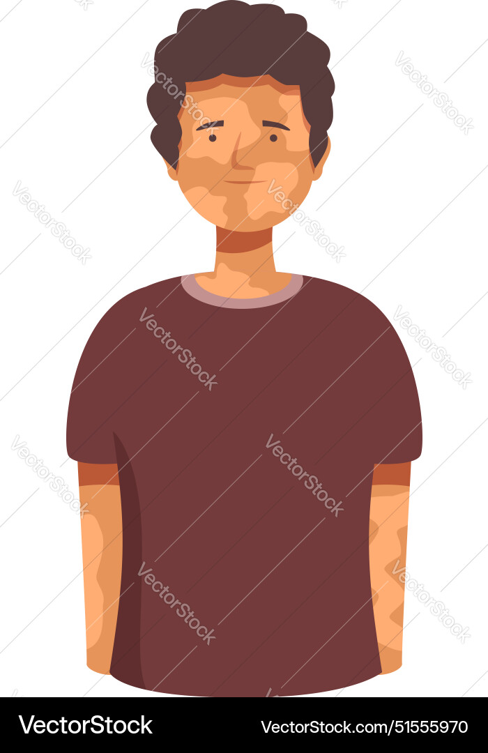 Young man with vitiligo skin condition smiling Vector Image
