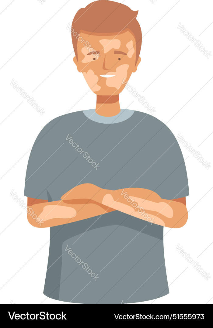 Young man with vitiligo skin condition smiling Vector Image