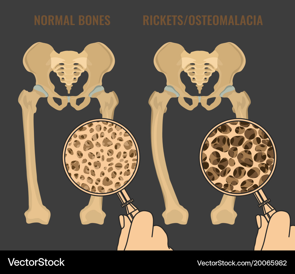 Rickets scheme Royalty Free Vector Image - VectorStock