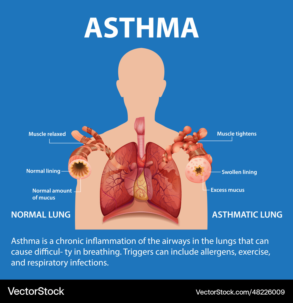 Comparing Normal And Asthma Lungs In Medical Vector Image