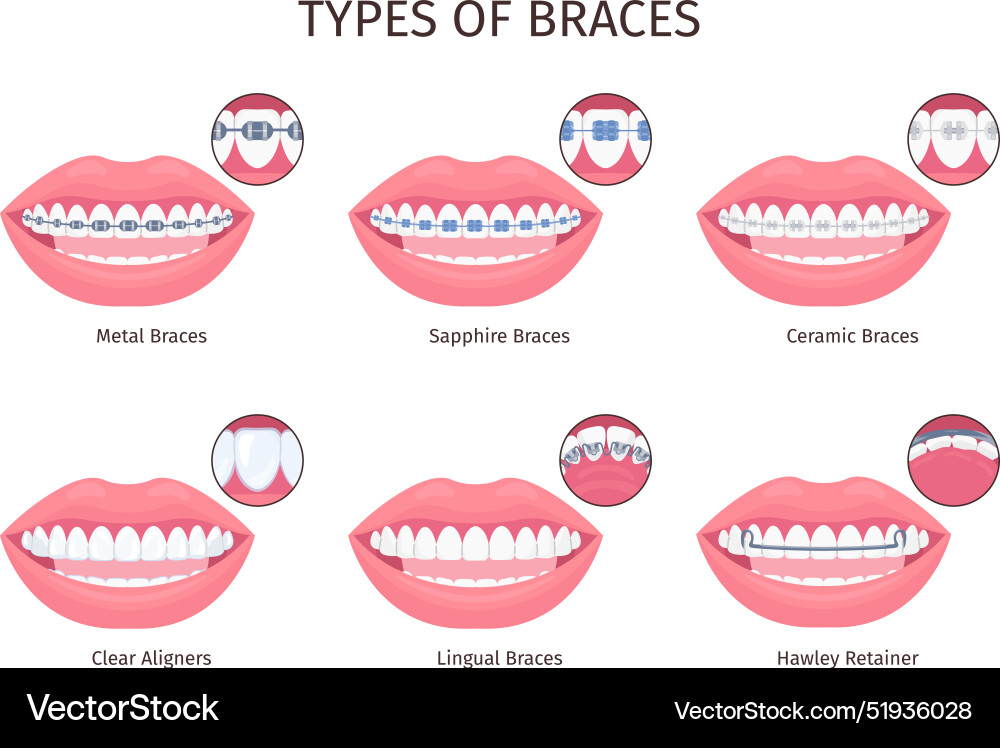 Braces types dental bracket teeth retainer type Vector Image