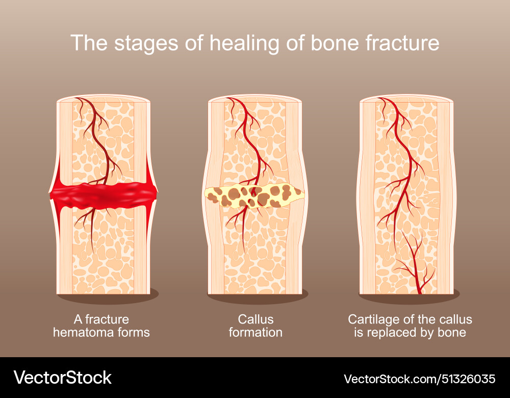 Healing of bone fracture Royalty Free Vector Image Healing of bone fracture Royalty Free Vector Image