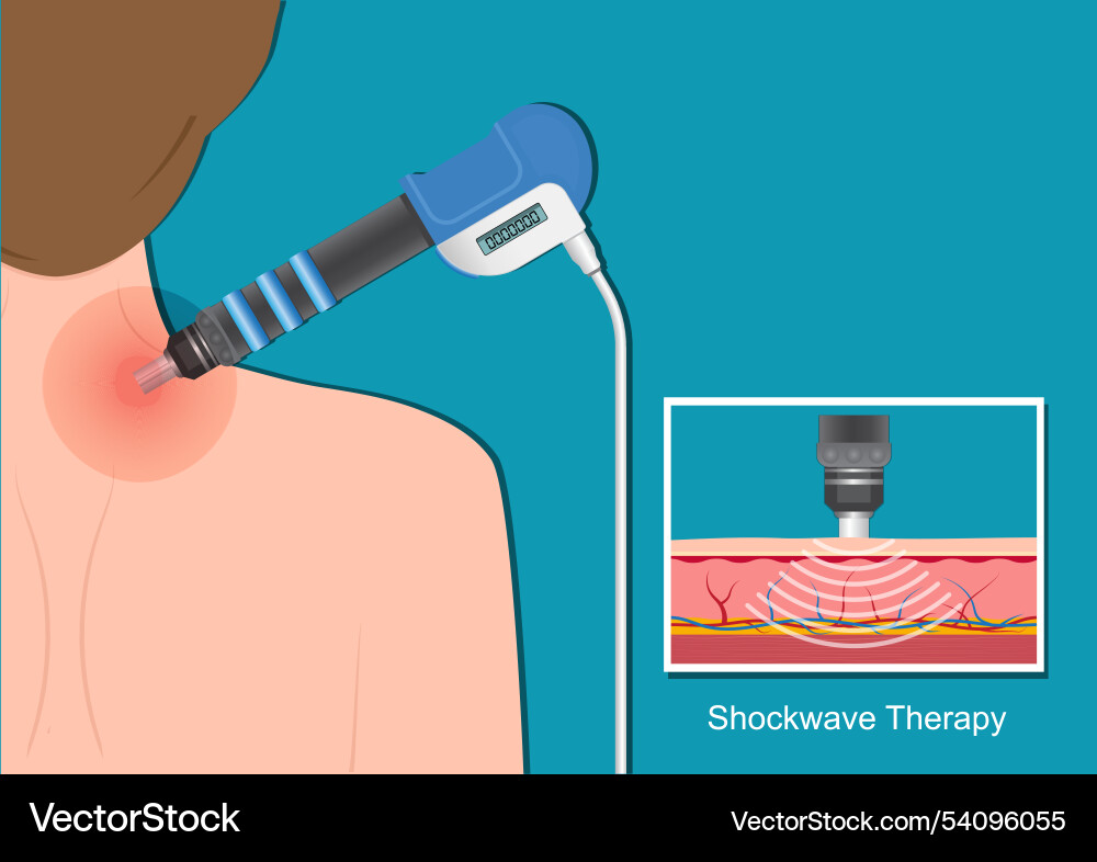 Extracorporeal shock wave therapy Royalty Free Vector Image