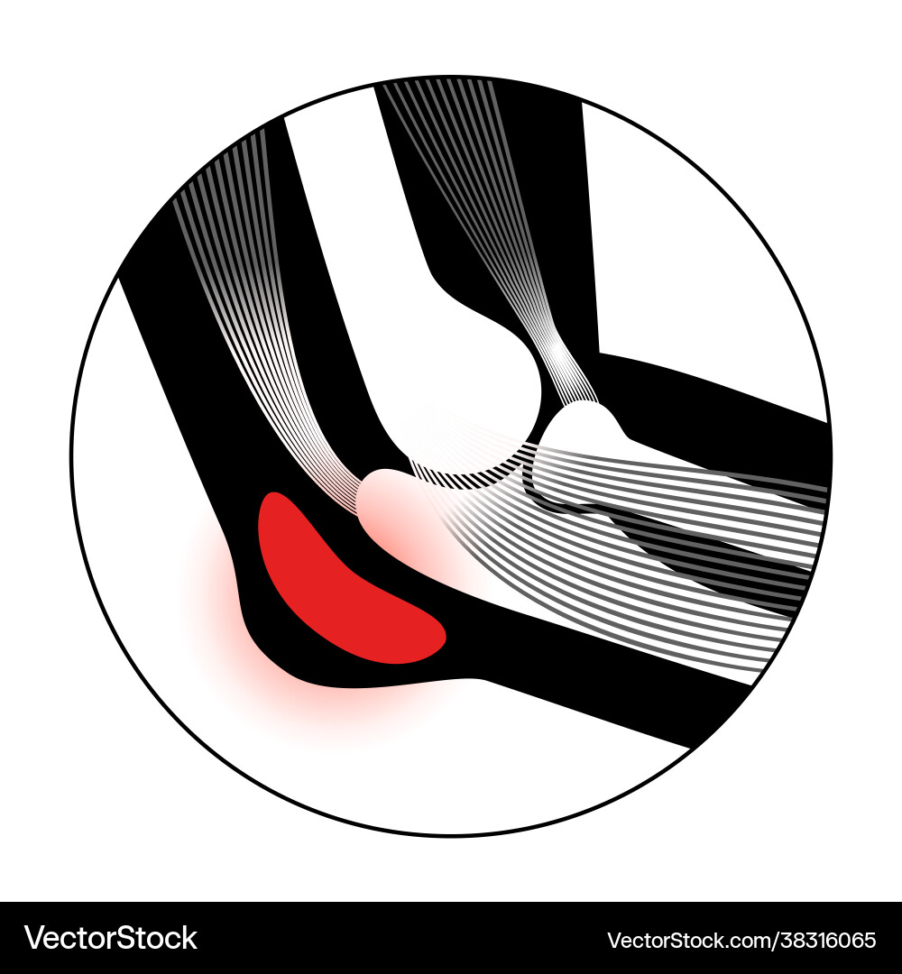 Student elbow bursitis Royalty Free Vector Image