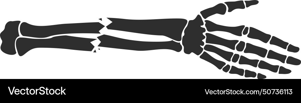 Broken hand bones bone fracture injury icon Vector Image