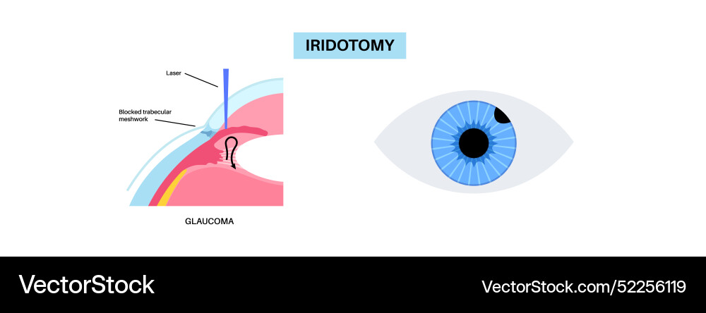 Iridectomy medical poster Royalty Free Vector Image