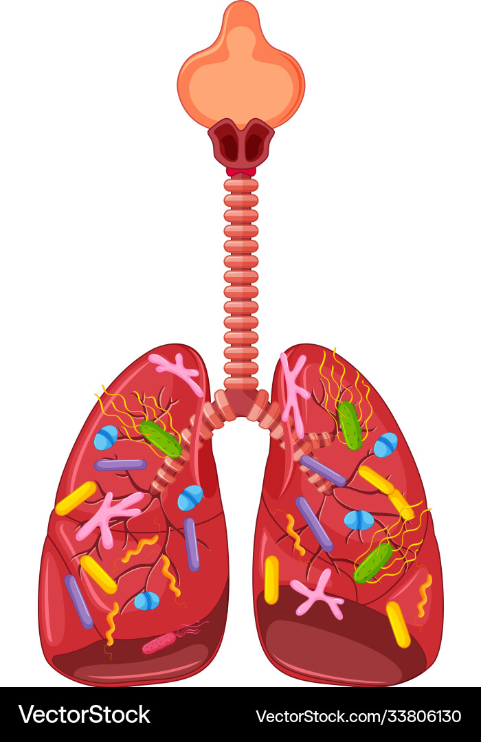 Bacterial lung infection anatomy Royalty Free Vector Image