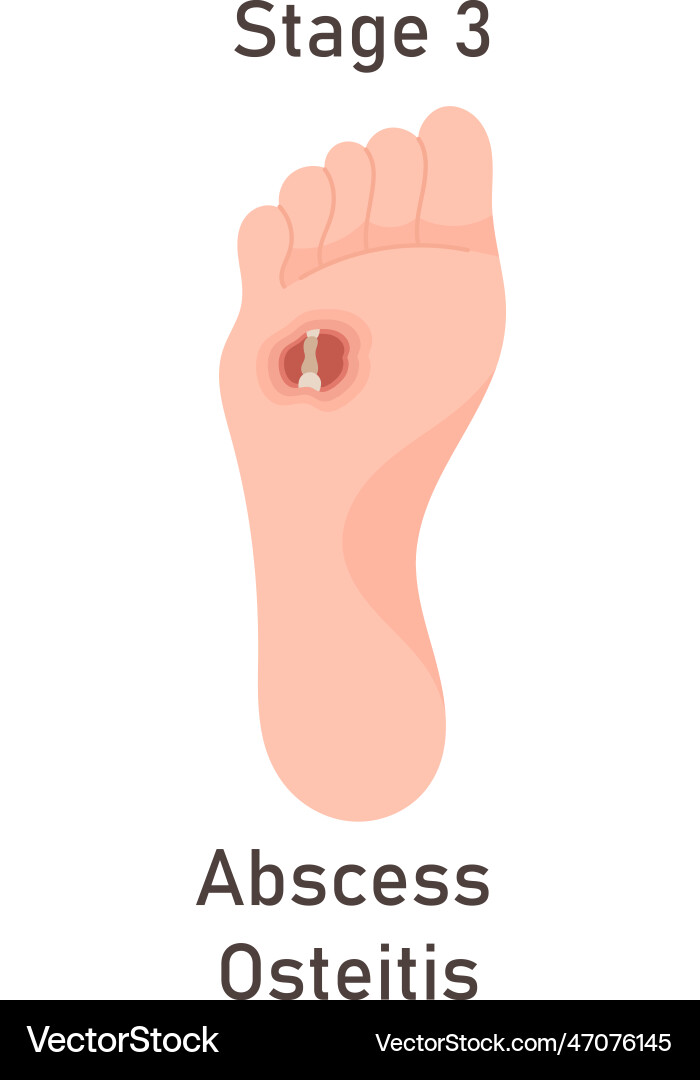 Abscess osteitis foot disease Royalty Free Vector Image
