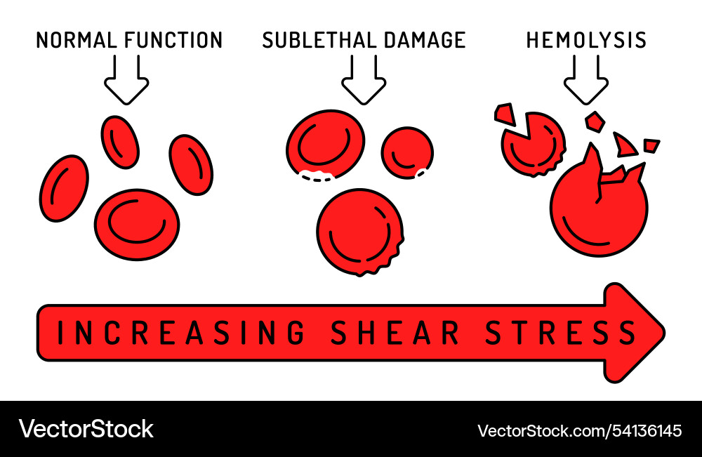 Hemolytic anemia infographic Royalty Free Vector Image