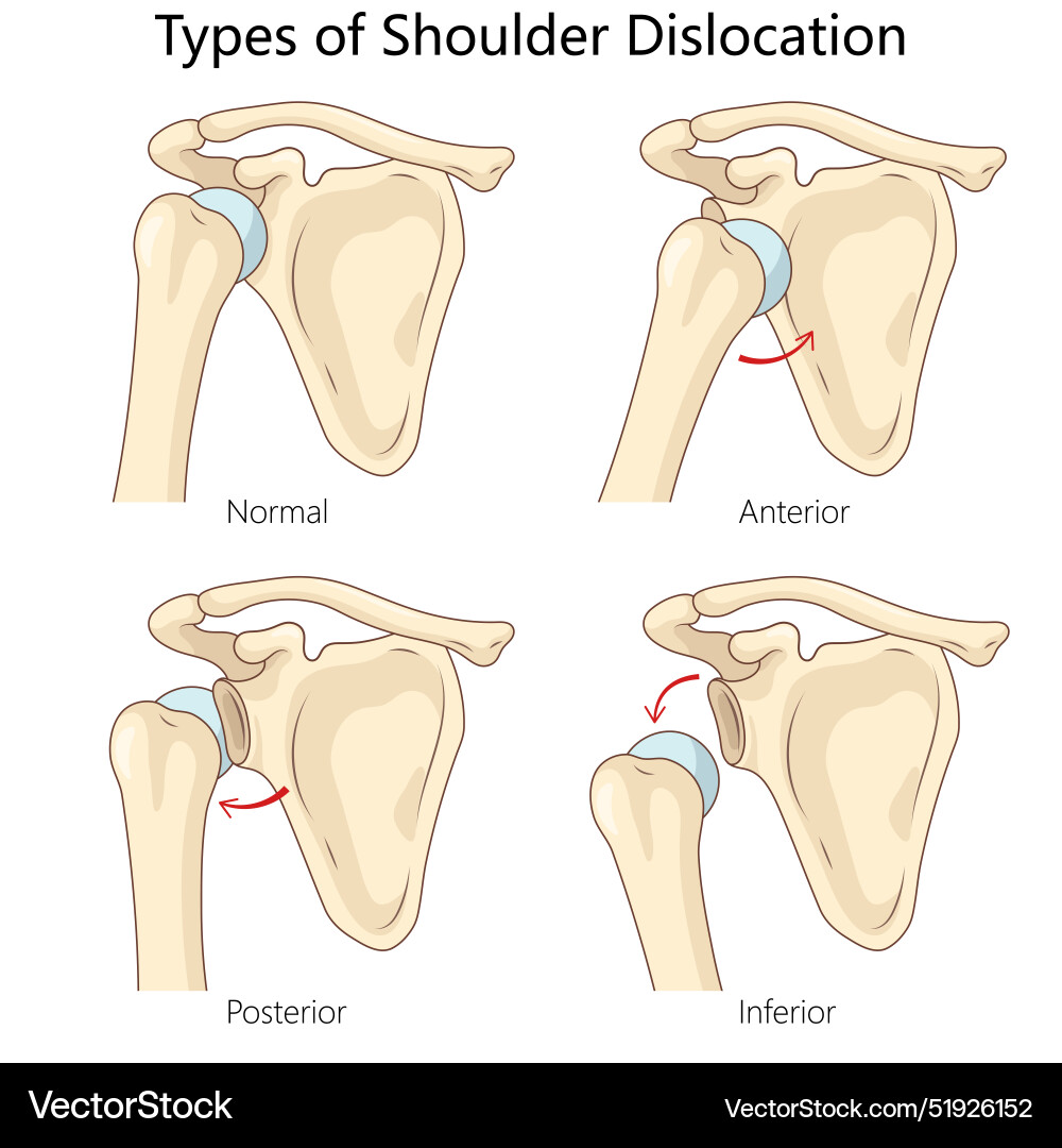 Types of shoulder dislocation diagram medical Vector Image