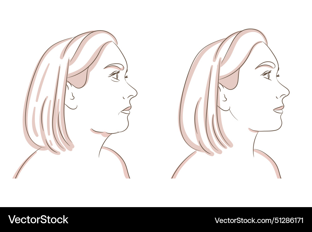 Reduce double chin jawline plastic Royalty Free Vector Image
