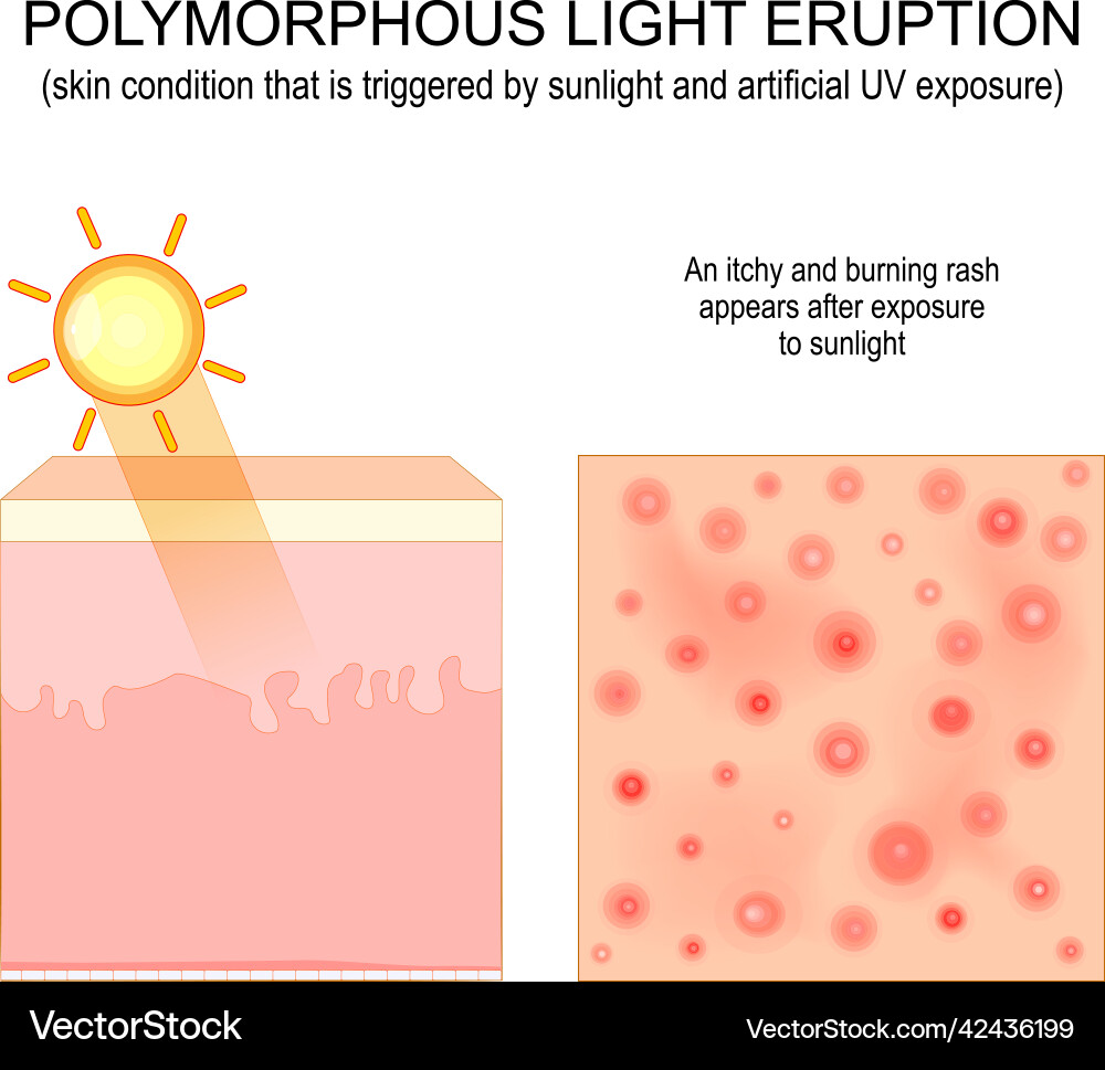 Polymorphic light eruption Royalty Free Vector Image