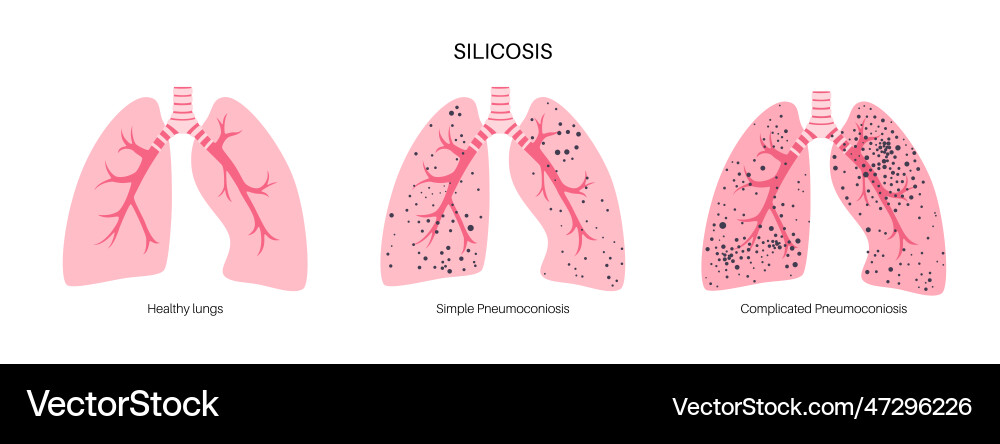 Silicosis dust in lung Royalty Free Vector Image