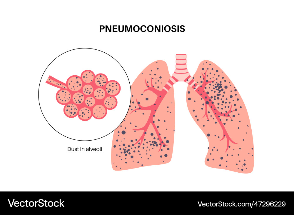 Pneumoconiosis lung disease Royalty Free Vector Image