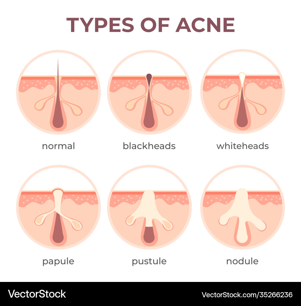Acne Types: Pimple Anatomy & Structure Vector Image