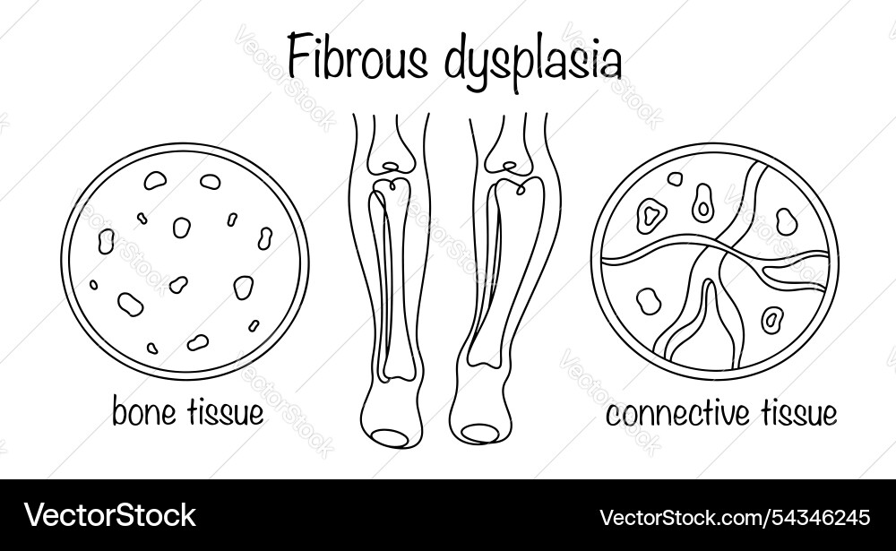 Fibrous dysplasia Royalty Free Vector Image - VectorStock