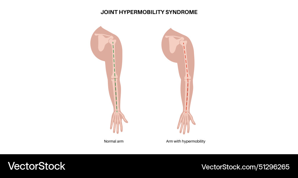 Joint hypermobility poster Royalty Free Vector Image
