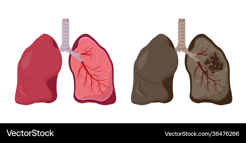 Healthy And Unhealthy Lungs Lung Damage And Emphysema, Illustration