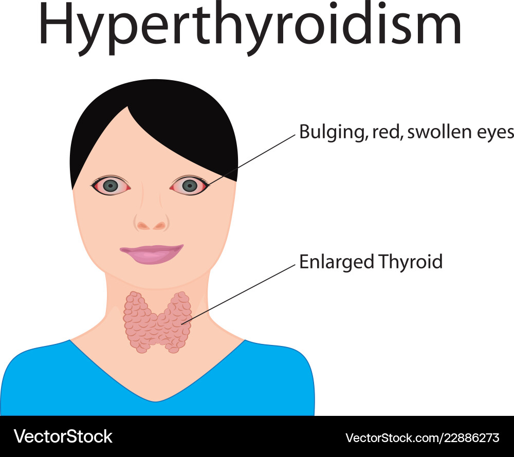 Hyperthyroidism enlarged thyroid endocrine Vector Image