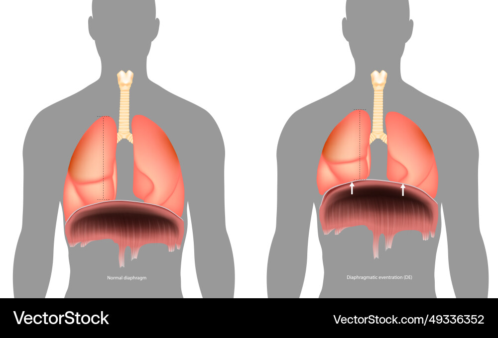 Normal diaphragm or diaphragmatic eventration Vector Image