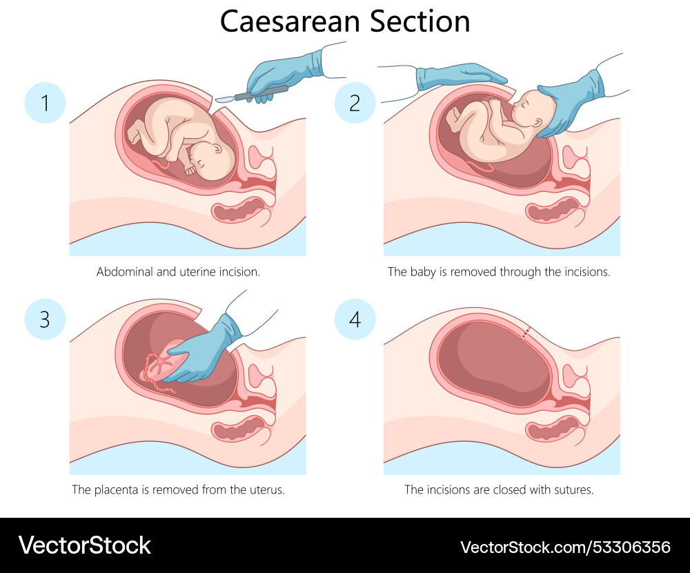 Caesarean section procedure diagram medical Vector Image