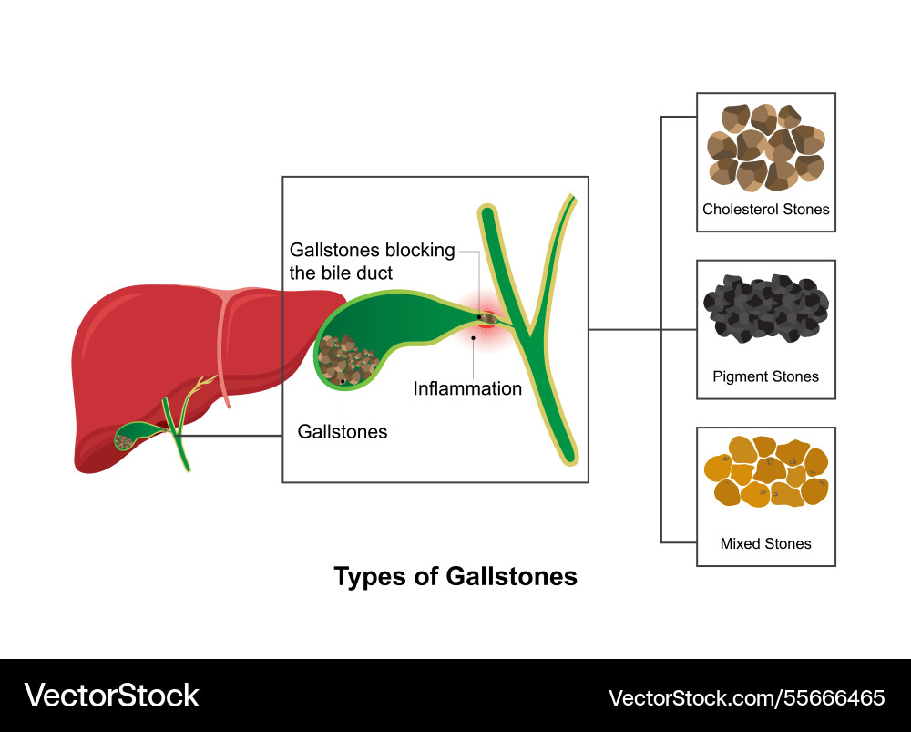 There are three main types of gallstones Vector Image