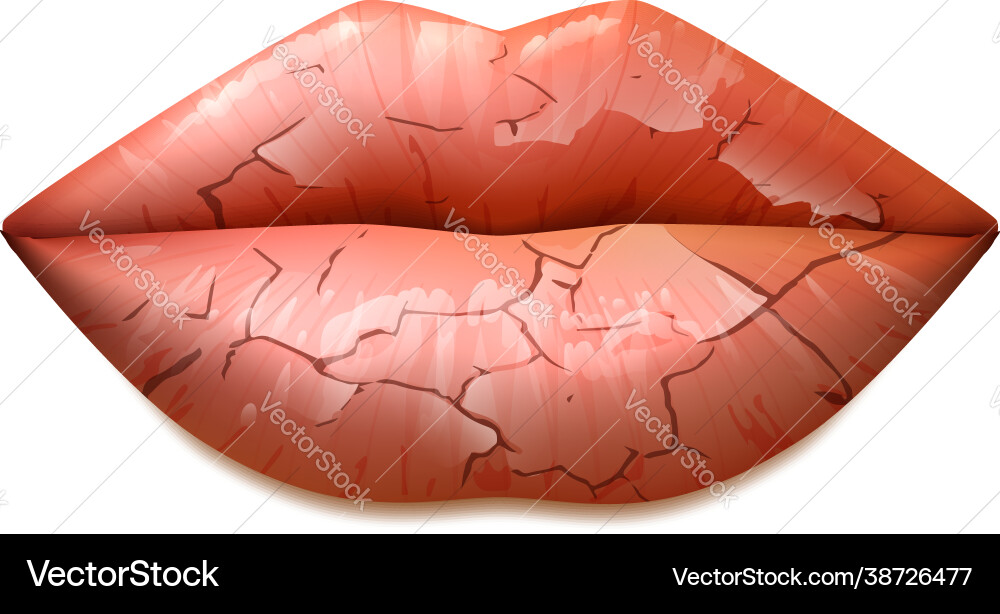 Dry lips Royalty Free Vector Image - VectorStock