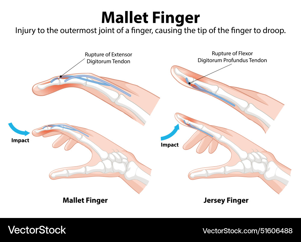 Finger tendon injuries and impacts Royalty Free Vector Image