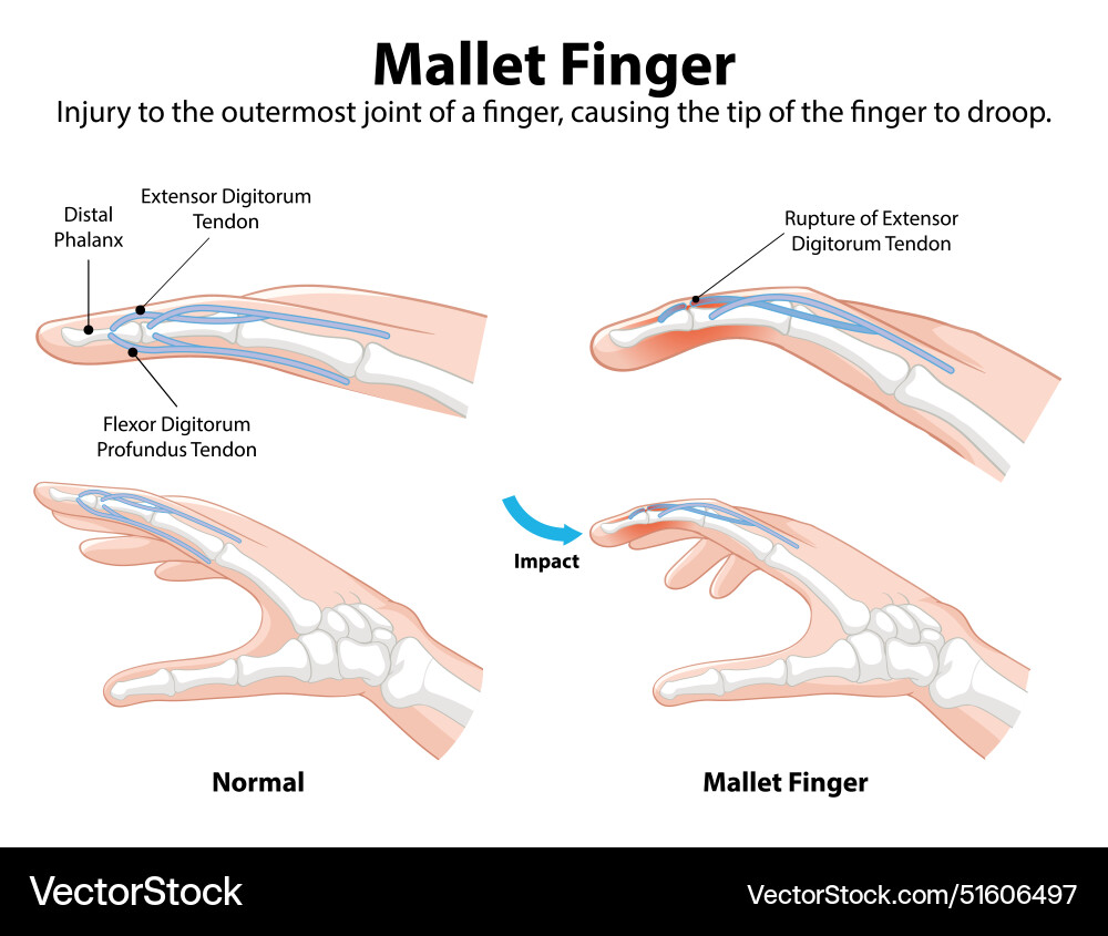 Diagram showing normal and mallet finger Vector Image
