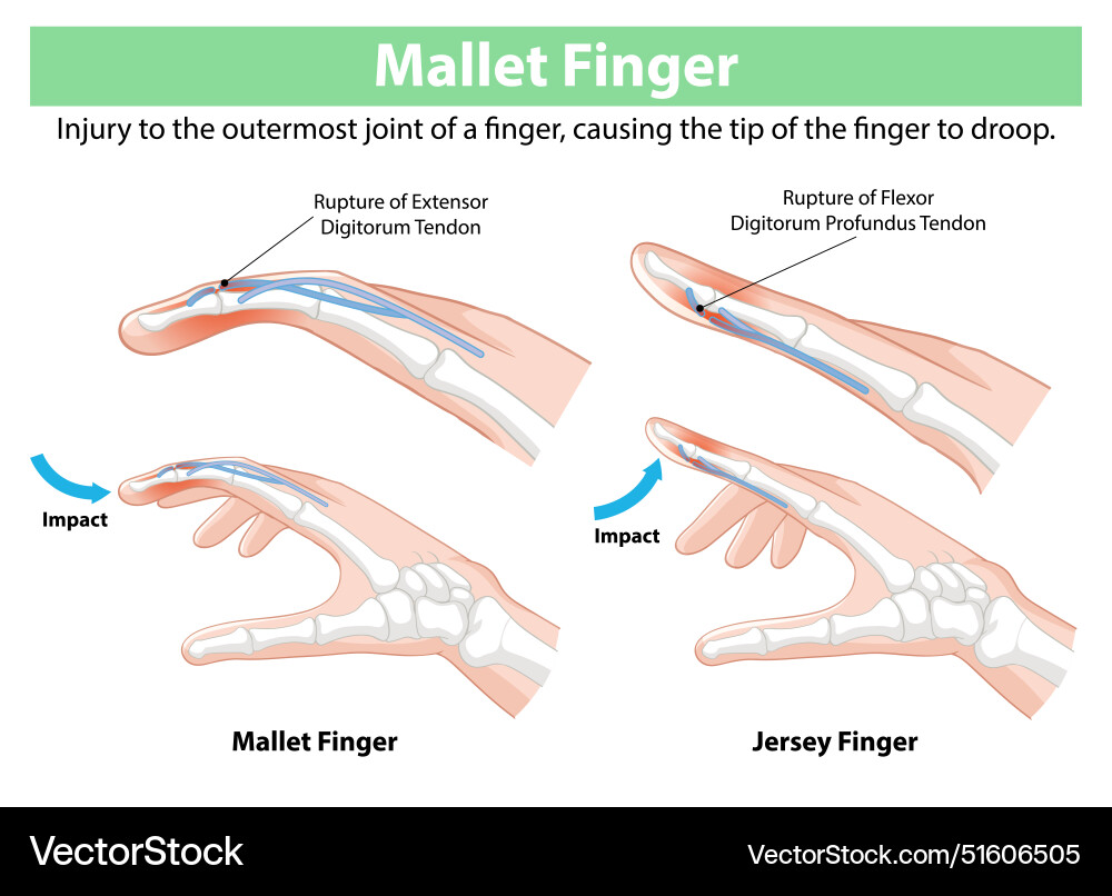 Finger tendon injuries and impacts Royalty Free Vector Image