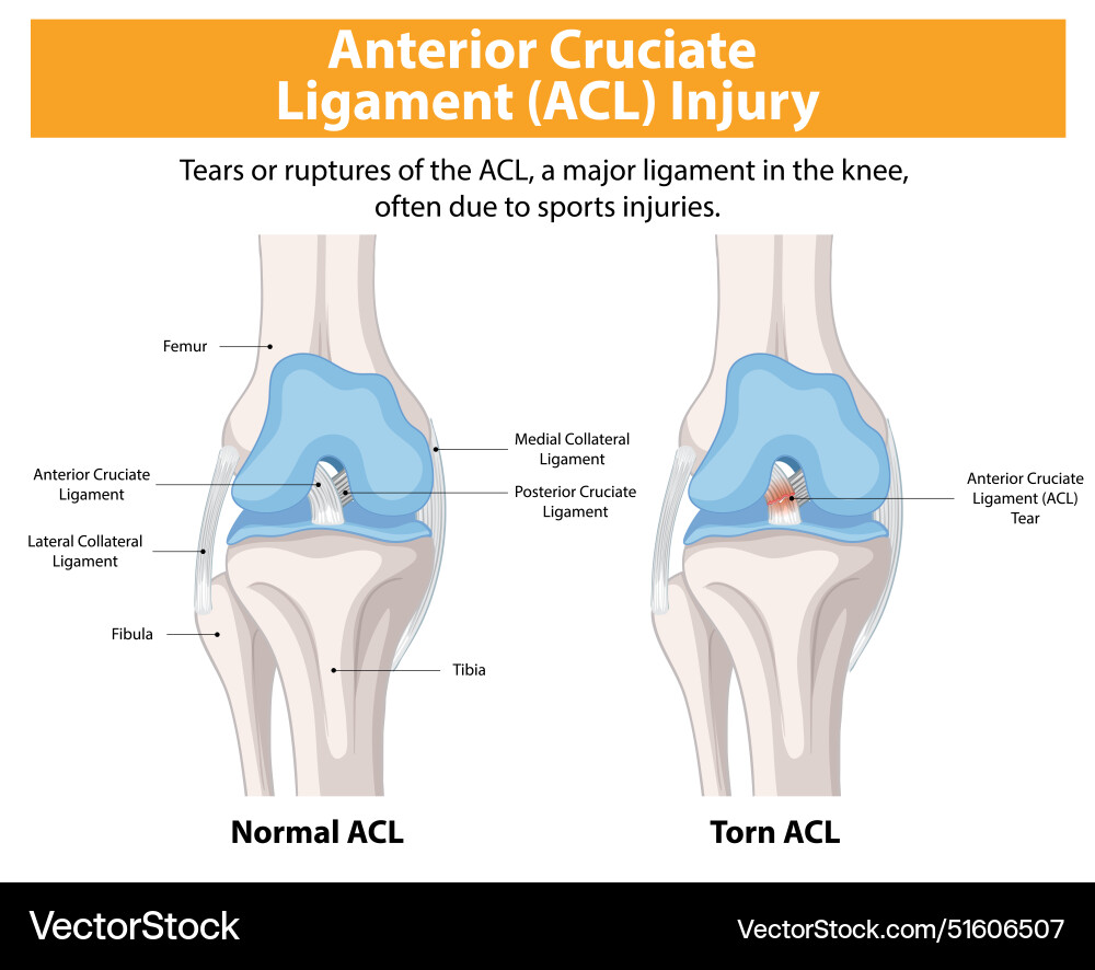 Comparison of normal and torn acl in the knee Vector Image