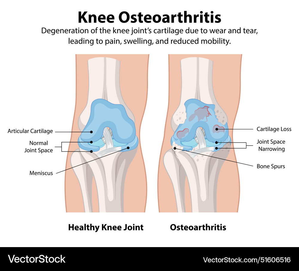 Gesundes Kniegelenk vs osteoarthritis Lizenzfreier Vektor