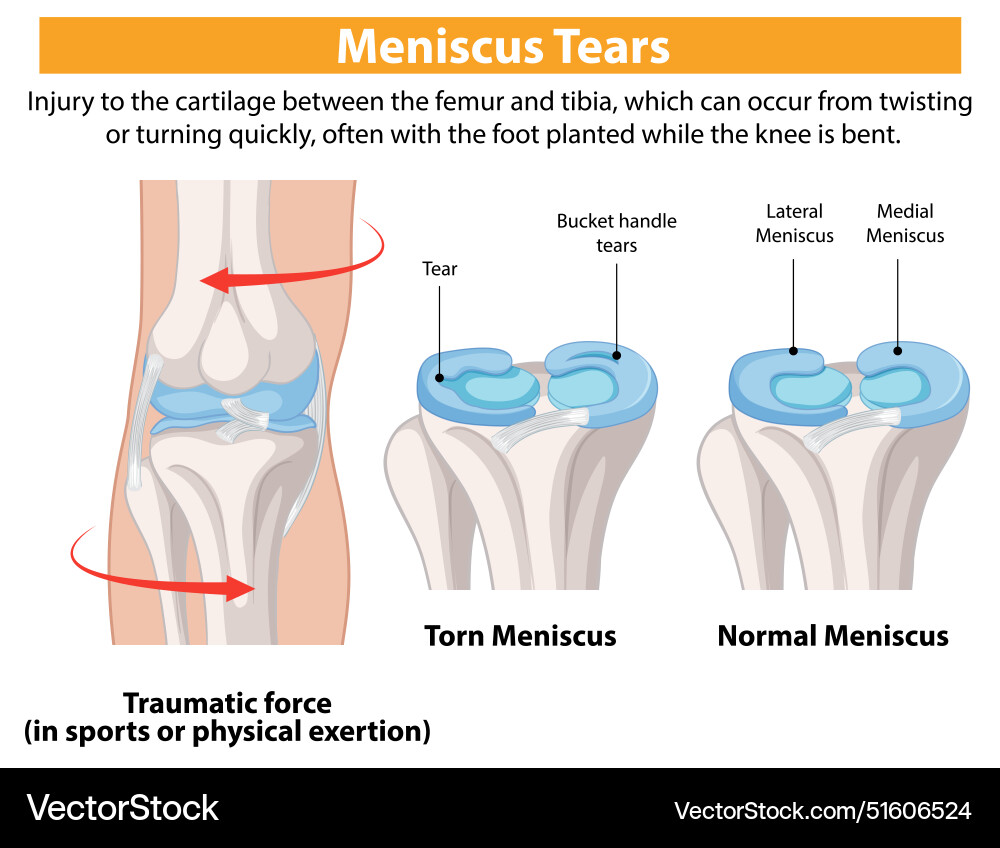 Normal and torn meniscus in knees Royalty Free Vector Image