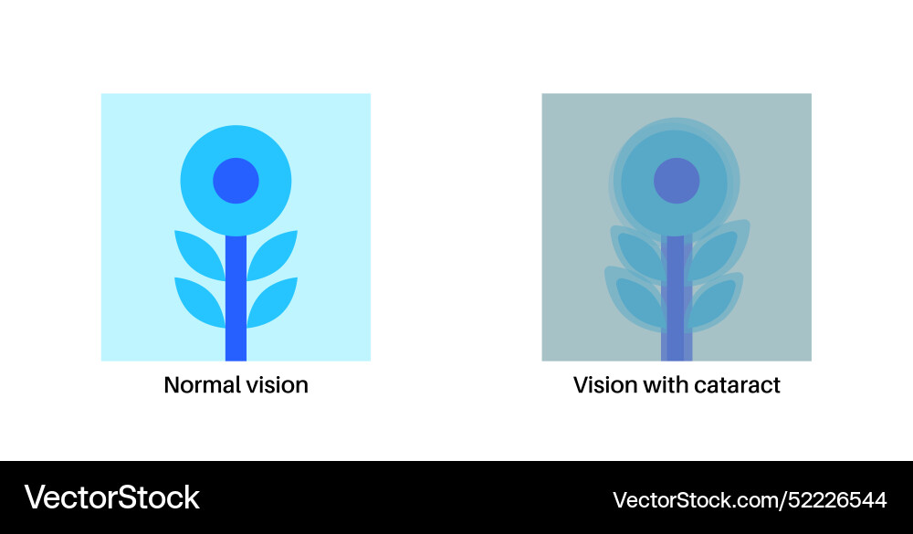 Cataract eye disease Royalty Free Vector Image