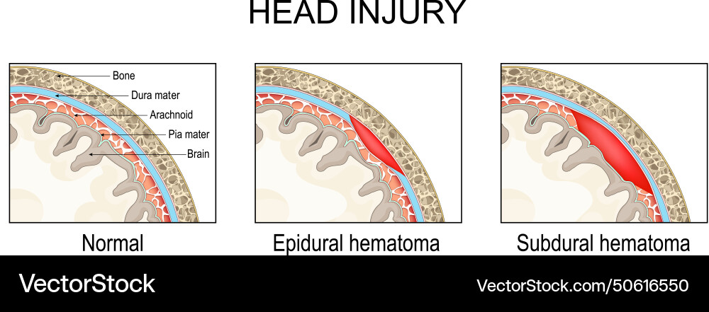 Epidural hematoma and subdural traumatic Vector Image