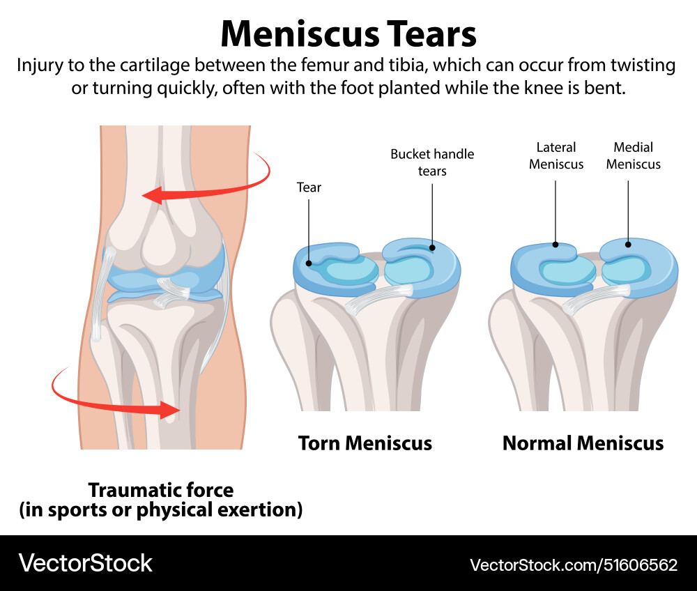 Meniscus Tear Anatomy & Types Royalty Free Vector Image