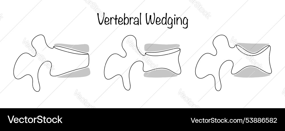 Vertebral wedging Royalty Free Vector Image - VectorStock