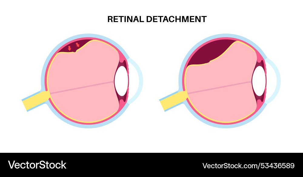 Retinal detachment eye disease Royalty Free Vector Image