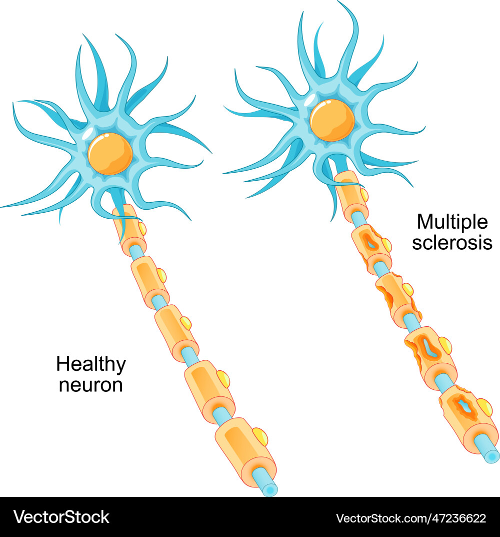 Multiple sclerosis autoimmune disease Royalty Free Vector