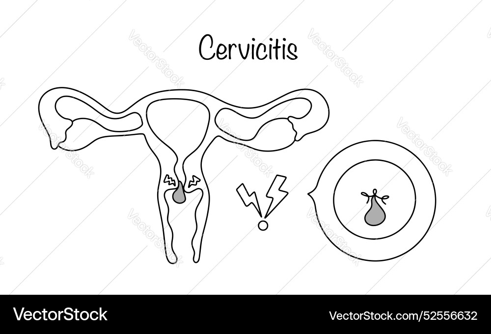 Cervicitis Royalty Free Vector Image - VectorStock