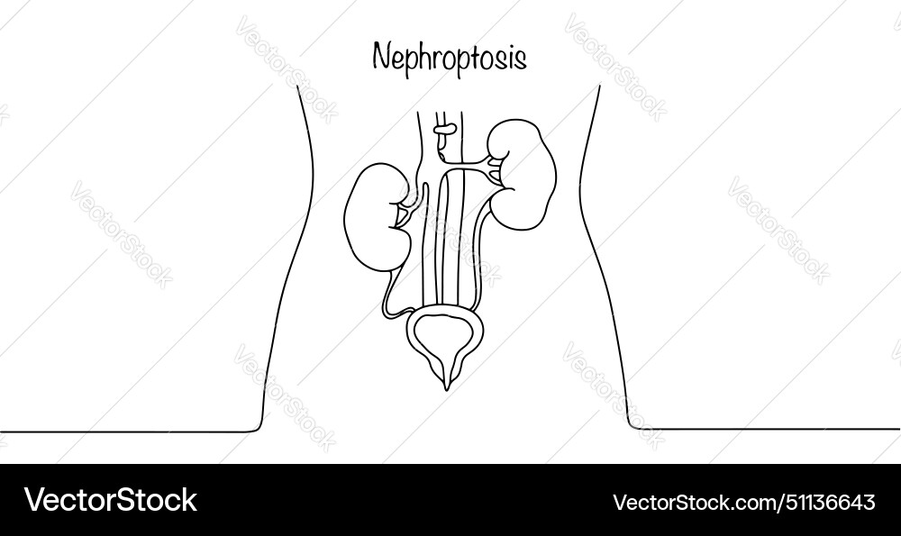 Nephroptosis Royalty Free Vector Image - VectorStock