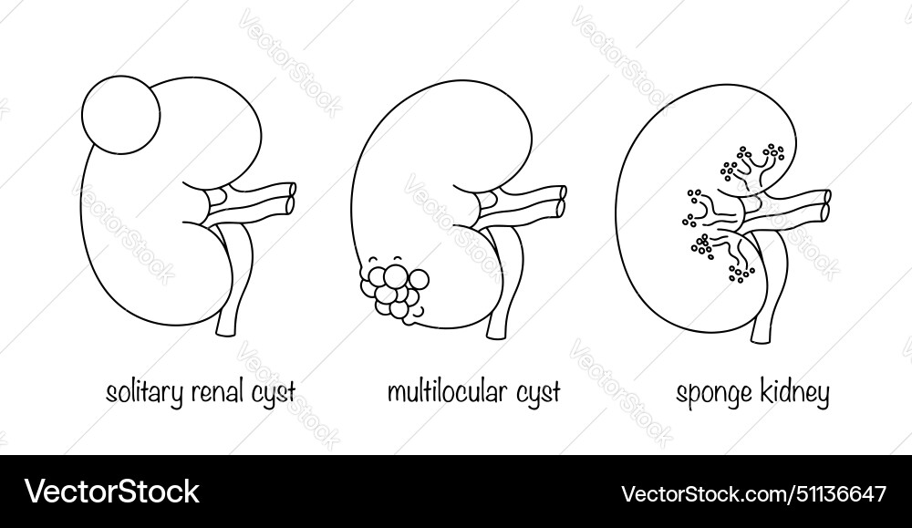 Kidney Cysts - Types & Anatomy Royalty Free Vector Image