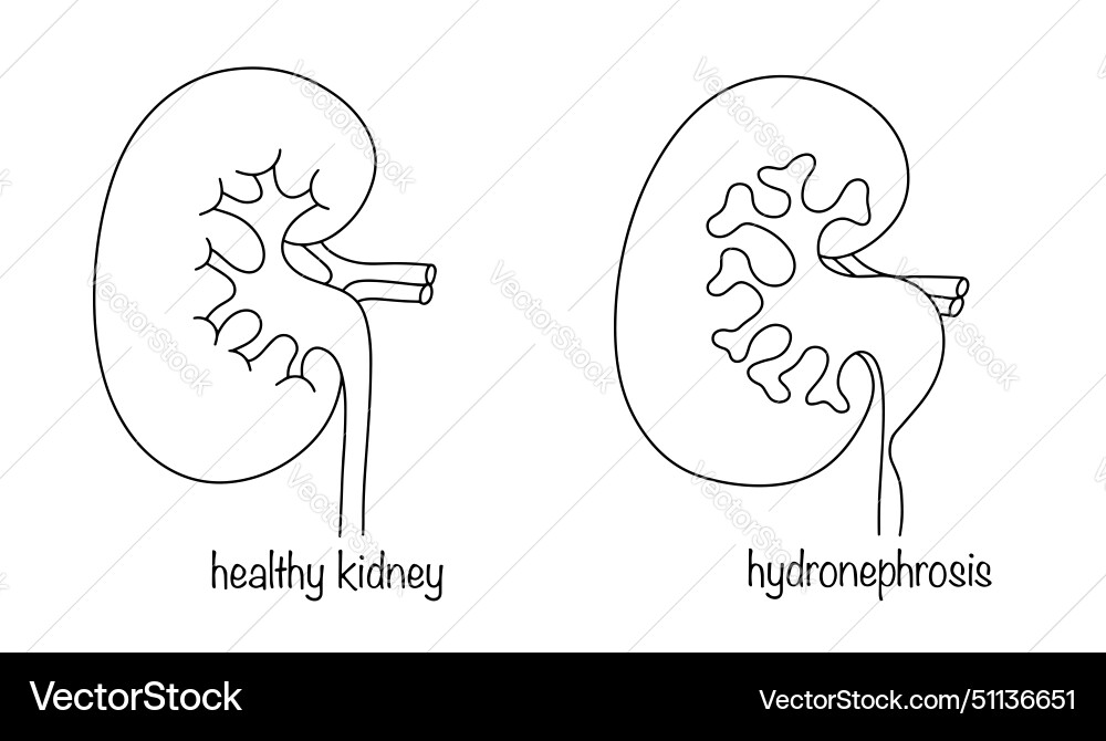 Hydronephrosis Grading Onen System Sfu Alternative Ags Comparison ...