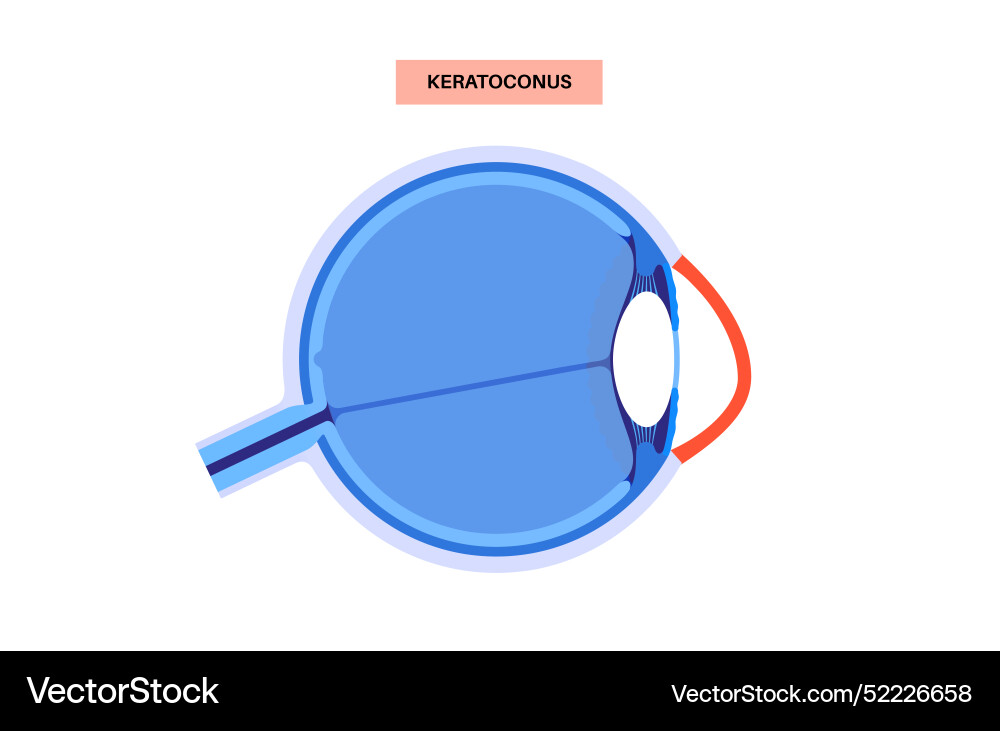 Cataract eye disease Royalty Free Vector Image