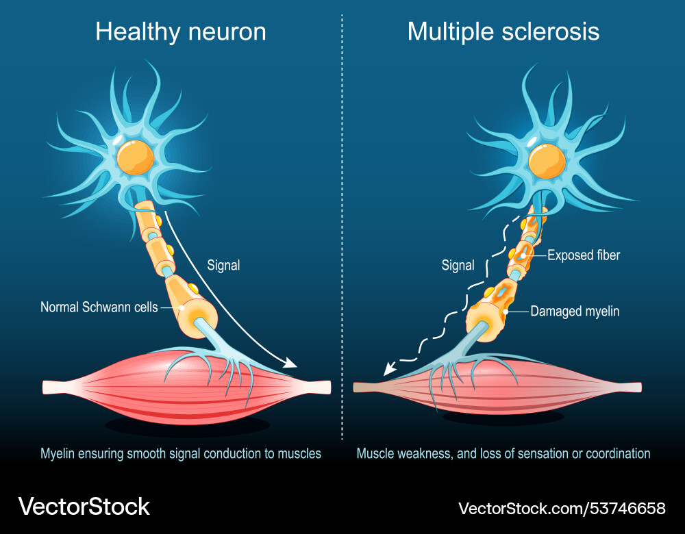 Multiple sclerosis neuron and muscle Royalty Free Vector