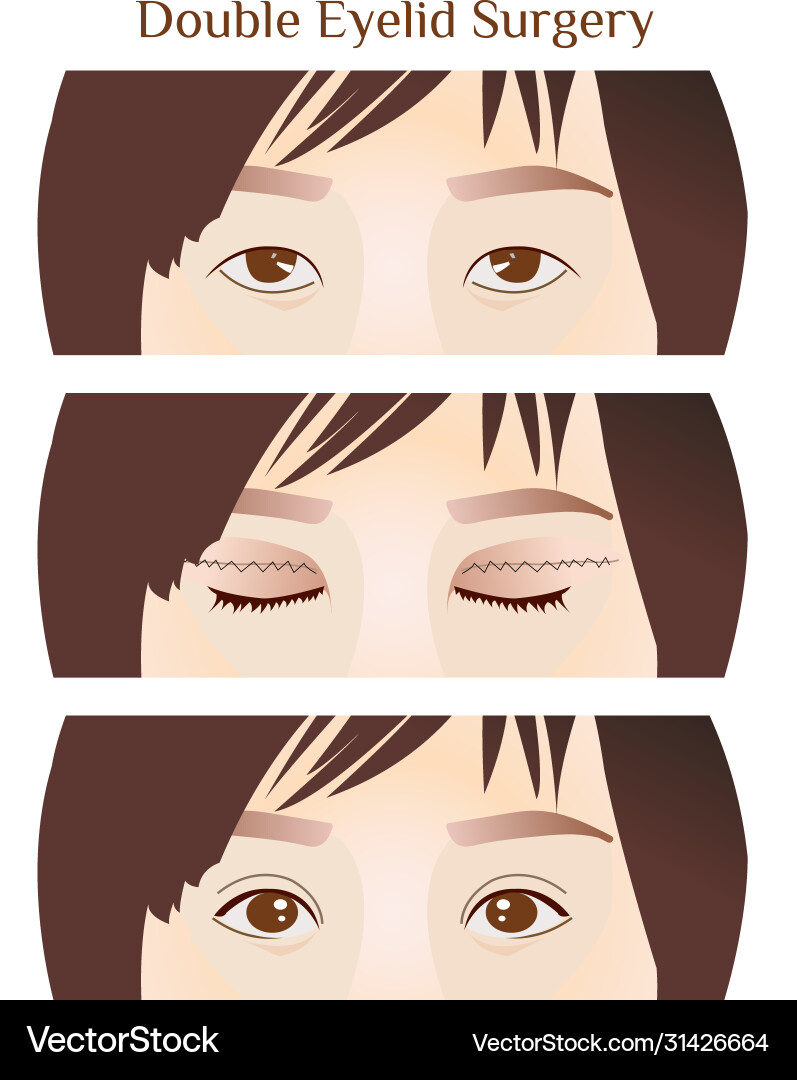 Step narrow-eyed to double eyelid surgery Vector Image