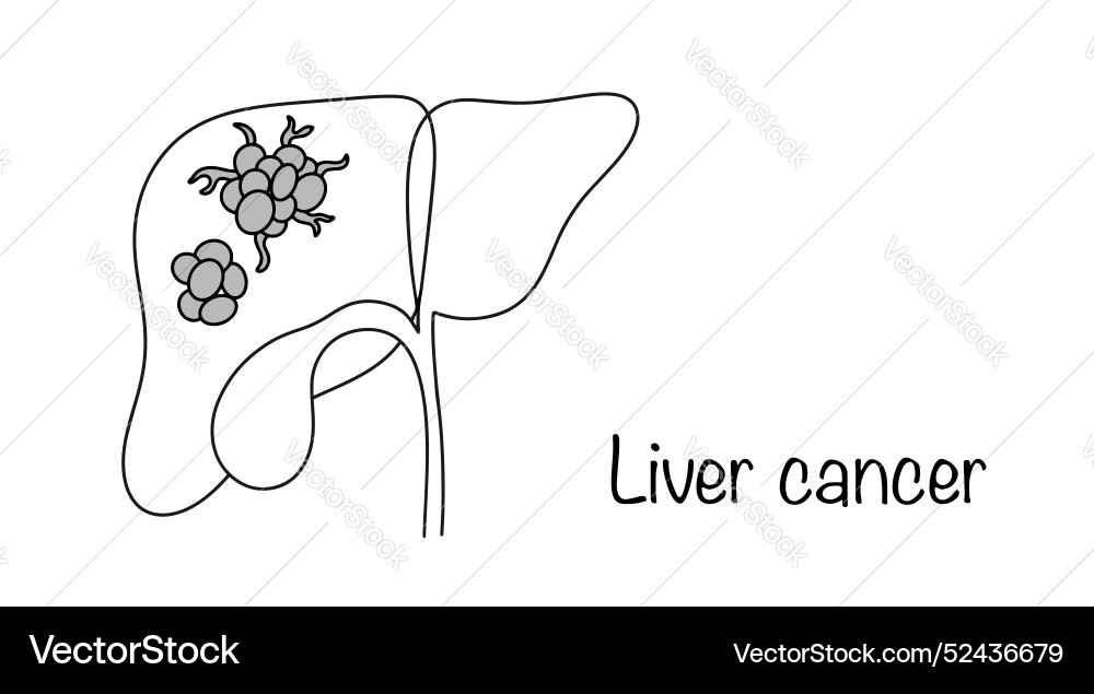 Liver cancer Royalty Free Vector Image - VectorStock